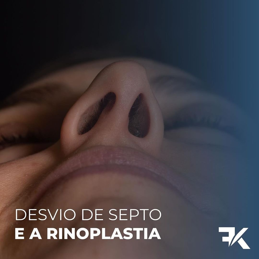 Desvio de Septo e a Rinoplastia - Dr. Fernando Krebs